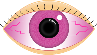 Pink Eye Facts - Eye Department Portland Eye Care & Eyewear